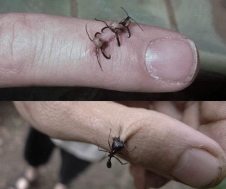 Ancient Healing Practices: Ants as Surgical Stitchers - Hasan Jasim