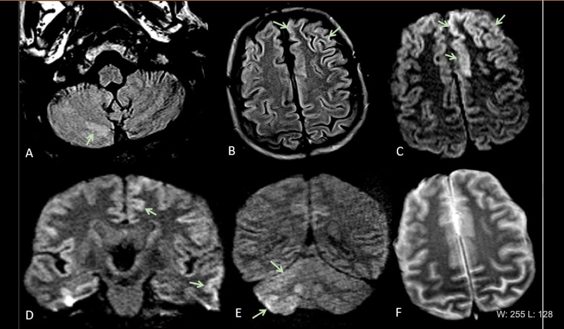 COVID-19 Inflicts Damage on Key Brain 'Control Center,' Revealed by ...